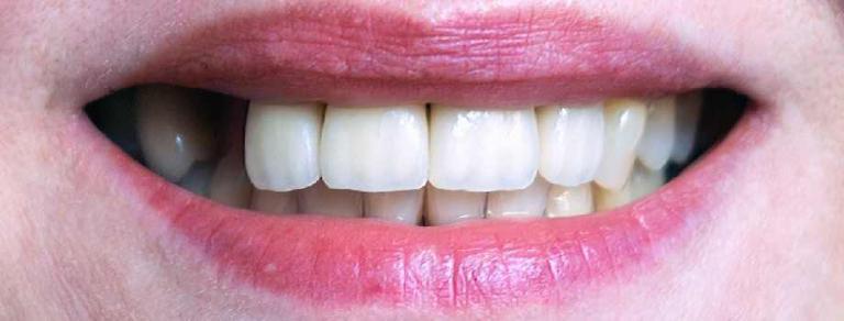 Full-Arch Replacements to Replace Missing Teeth Prevents Many Oral ...